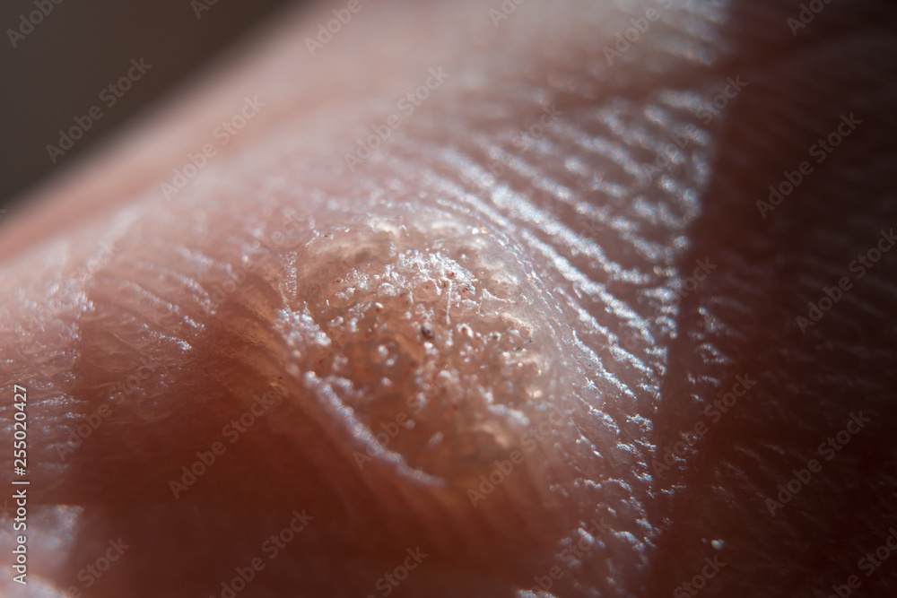 Verruca, warts removing concept Stock Photo | Adobe Stock