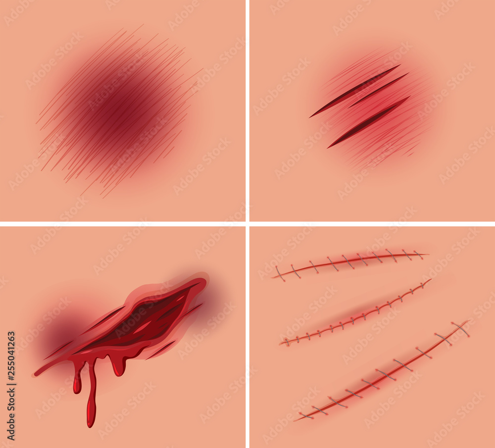 Set of open wound Stock Vector | Adobe Stock