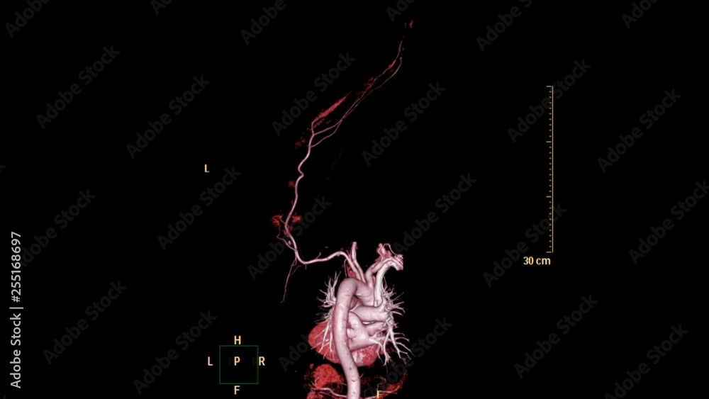 CTA brachial artery or CT scan of upper extremity or the Arm 3d ...