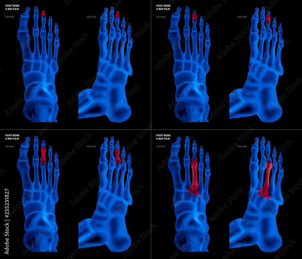 X-ray blue film collection of Middle toe foot bone with red highlights ...
