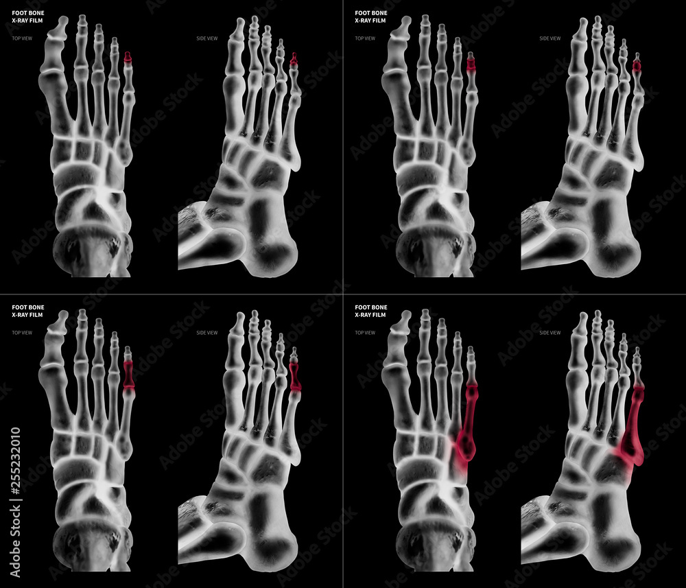 X-ray film collection of Little toe foot bone with red highlights on ...