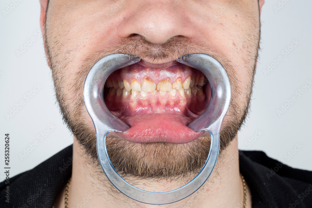 Frontal View Of Human Jaw With Overbite Dental Occlusion Stock Photo ...