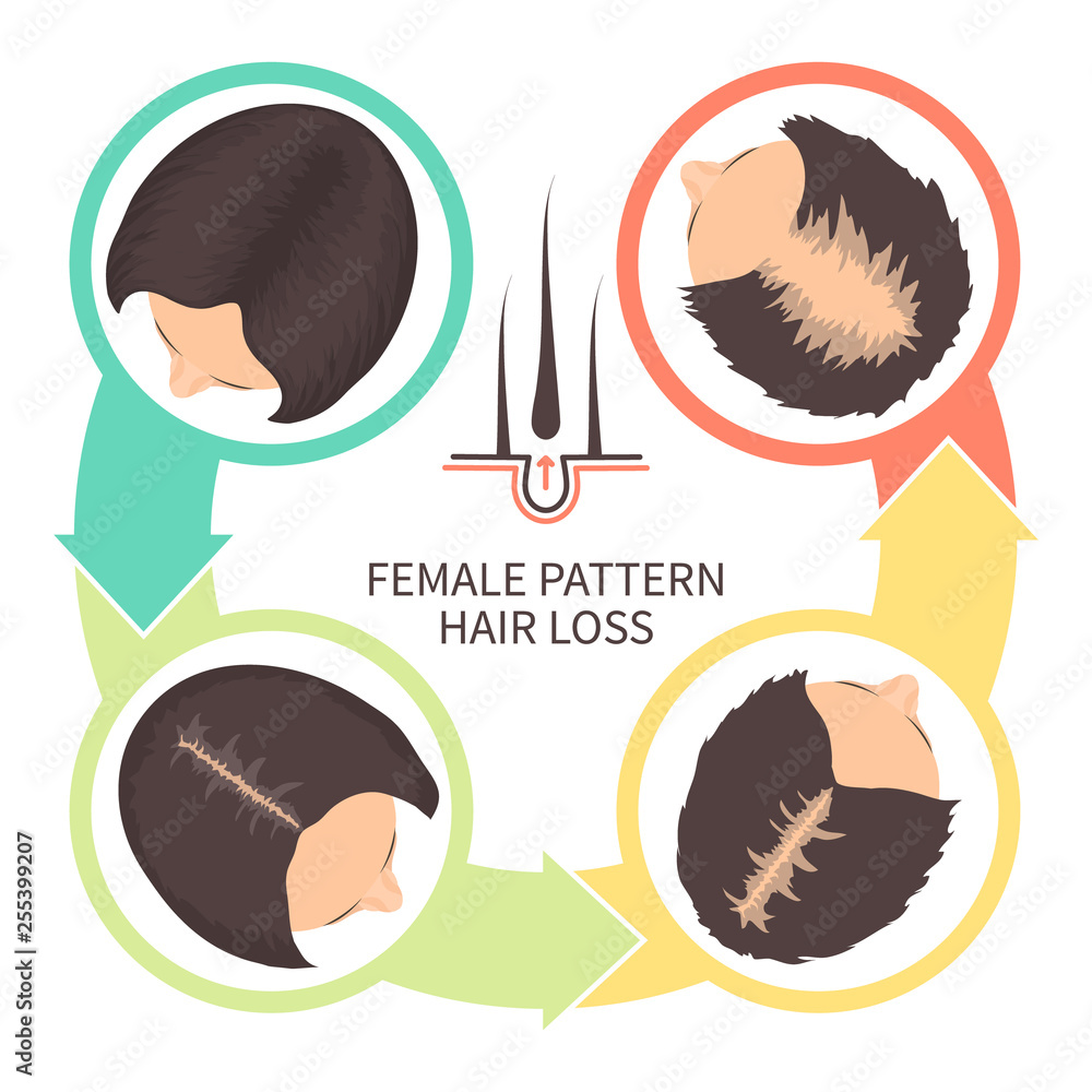 Female pattern hair loss set. Stages of baldness in women. Androgenetic ...