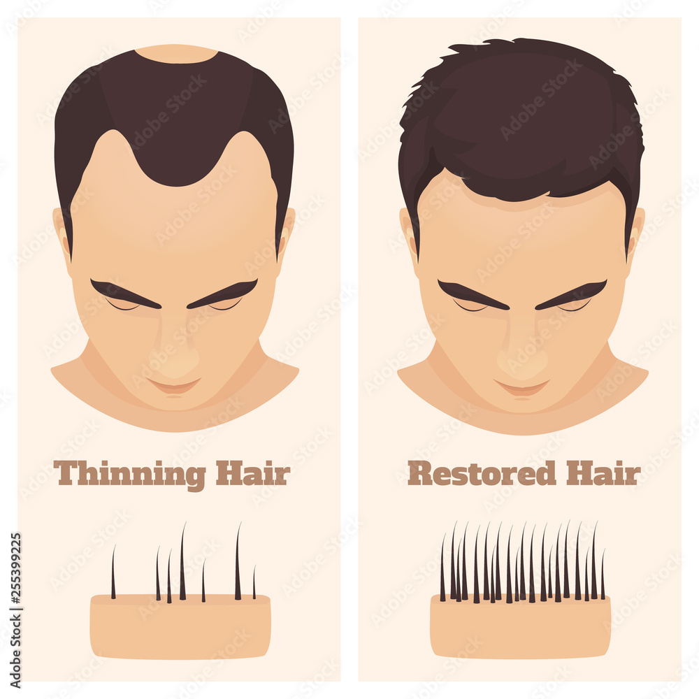 Man with thinning and restored hair. Male pattern alopecia set with ...