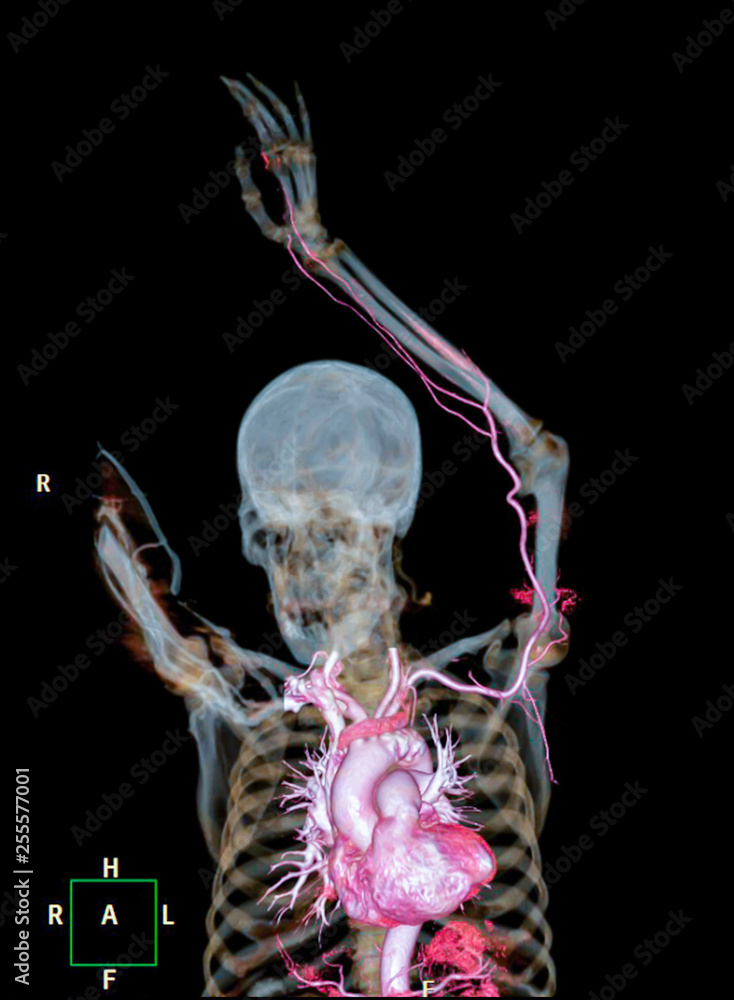 CTA brachial artery or CT scan of upper extremity or the Arm 3d ...