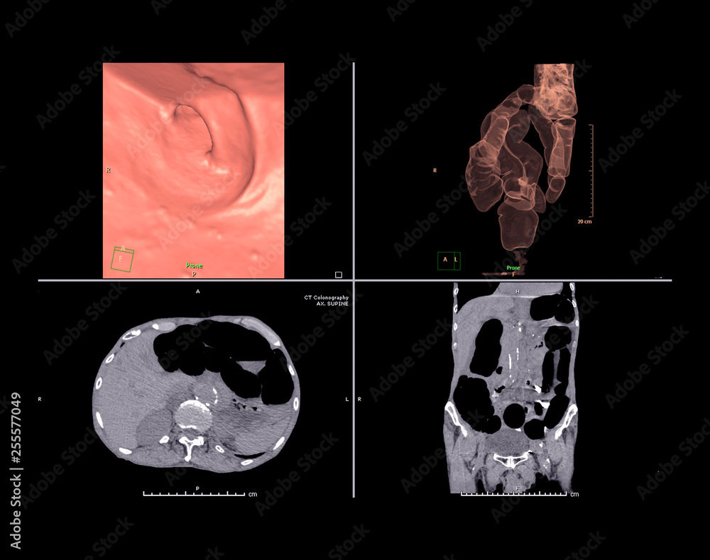 CT colonography or CT Scan of Colon axial view vs Coronal view and 3D ...