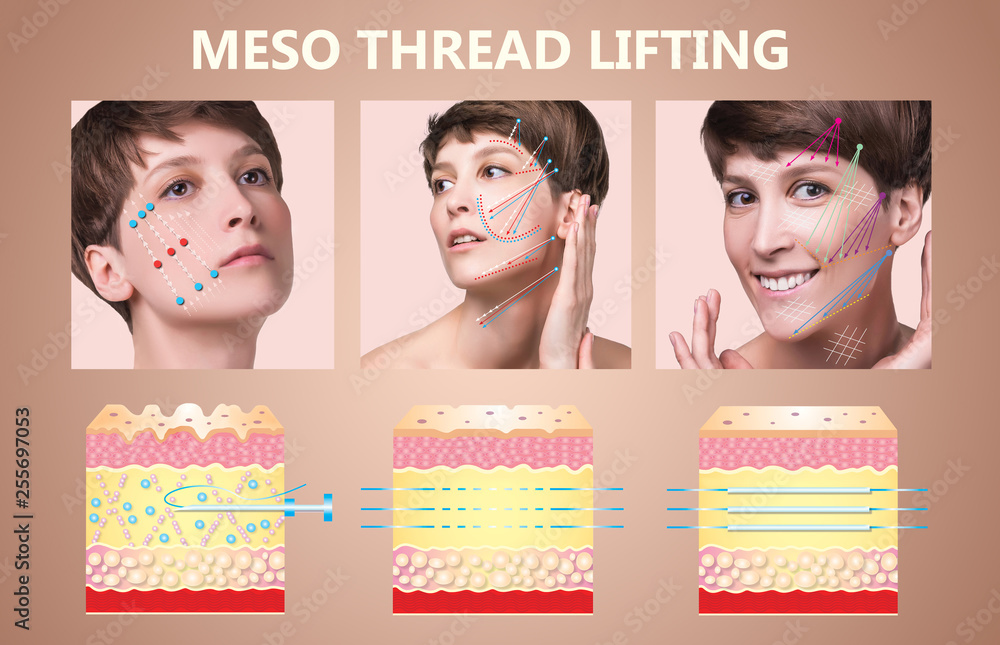 Meso thread Lift. Young female with clean fresh skin. Beautiful woman ...