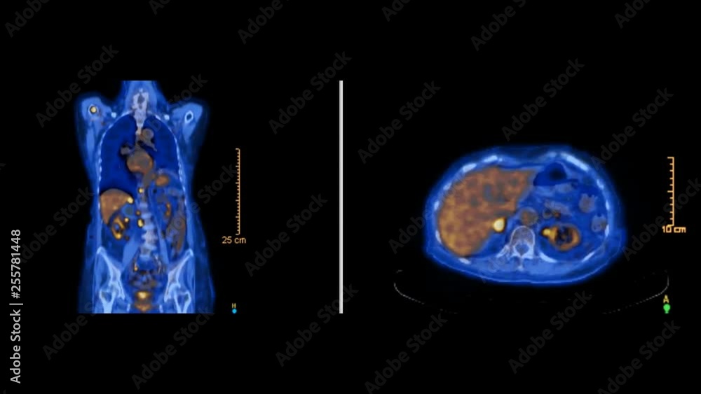 PET CT or Positron Emission Tomography of whole human body for finding ...