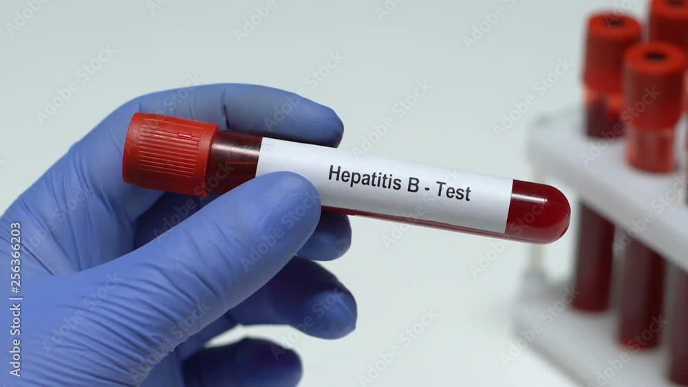Hepatitis B-test, doctor holding blood sample in tube close-up, health ...