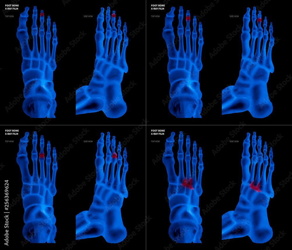 X-ray of collection arthritis middle toe joint foot bone red highlights ...
