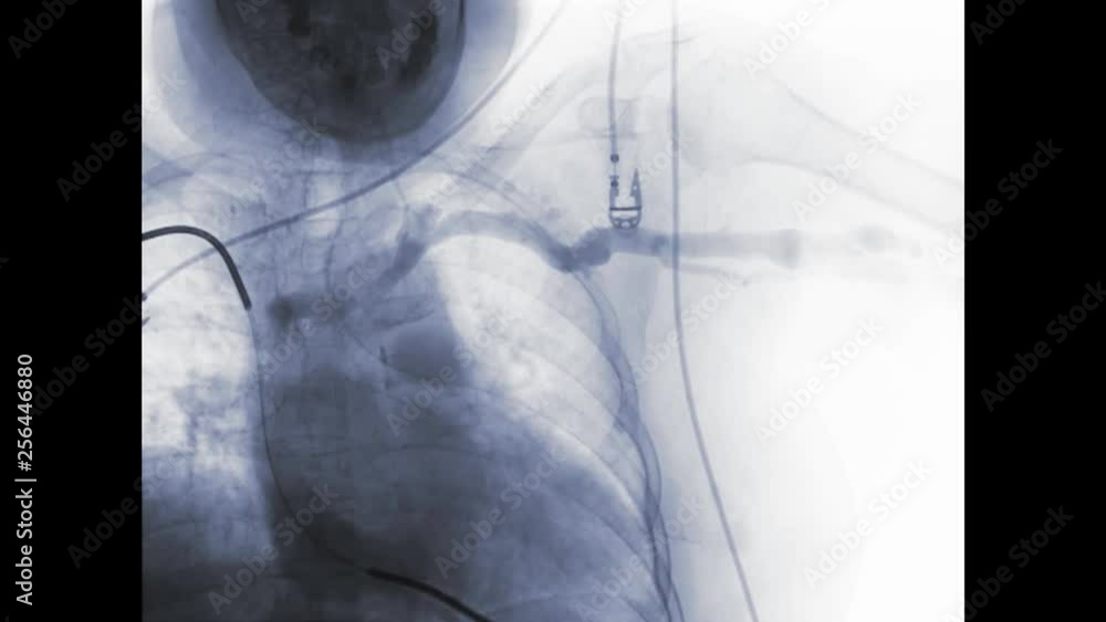 Percutaneous transluminal angioplasty or PTA of the arteries of the arm ...