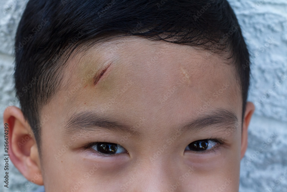 Close-up stale forehead of naughty young boy age 5 years old with ...