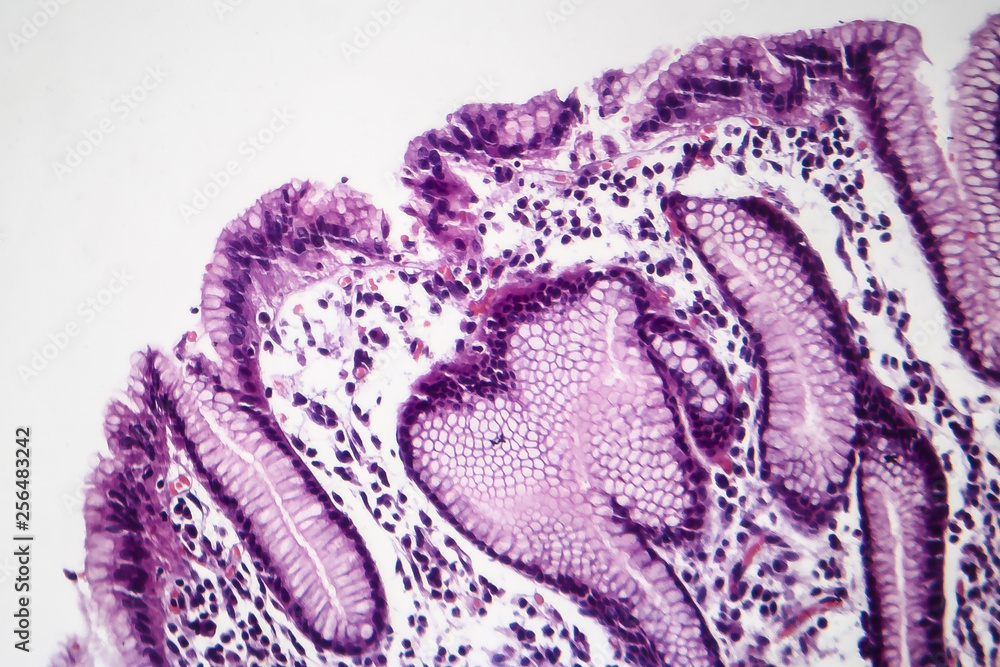 Histopathology of chronic superficial gastritis, light micrograph ...