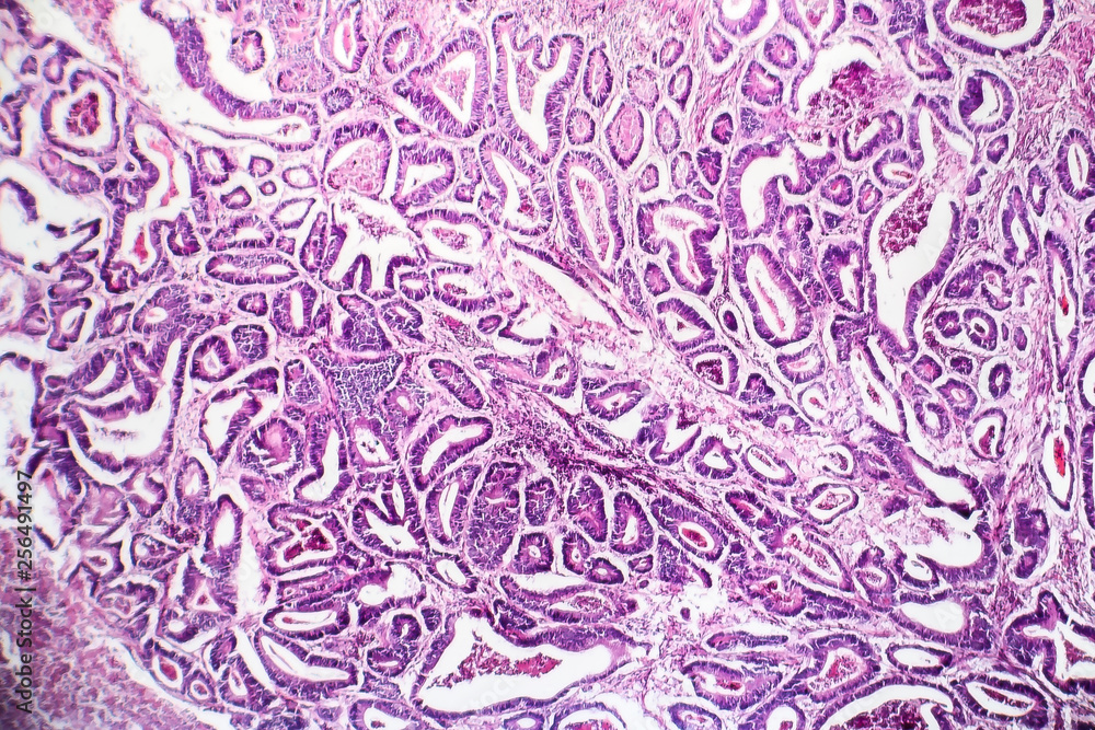 Colon cancer, light micrograph, photo under microscope Stock ...