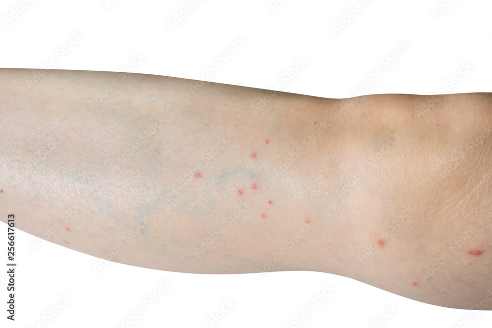 Close up of leg been bitten by ticks..Tick bites cause the skin around ...