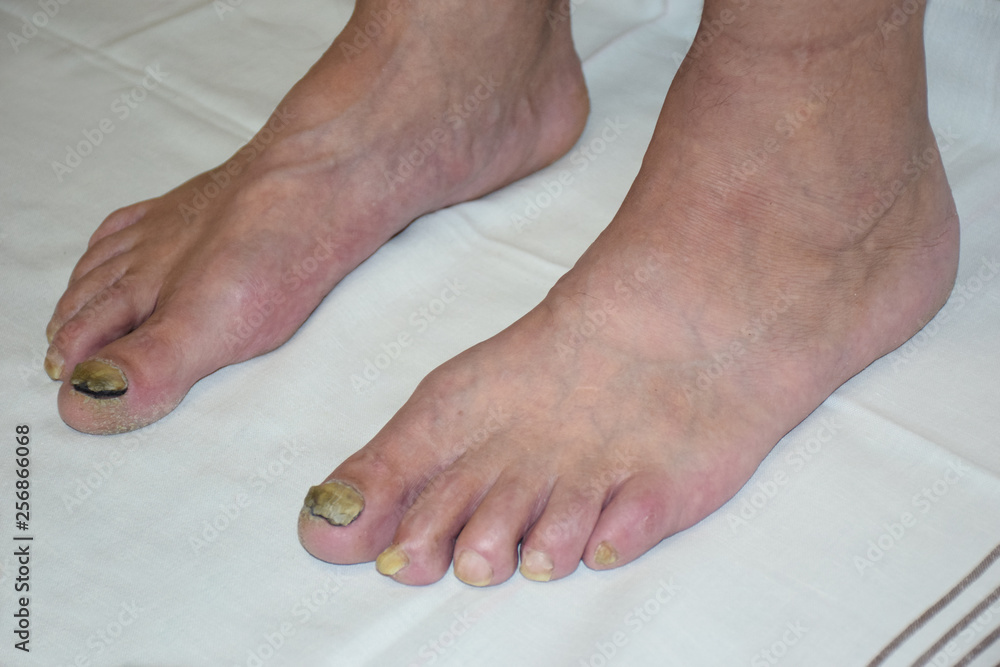 Foto de Two legs with nail fungus infected, right view. Close up of ...
