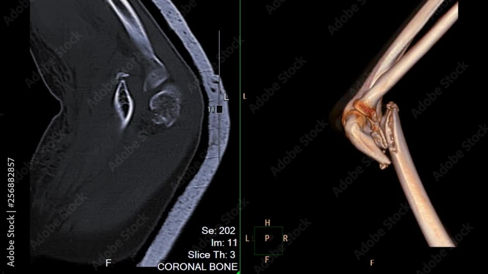 CT Elbow comparison Sagittal plane vs 3D rendering image showing ...