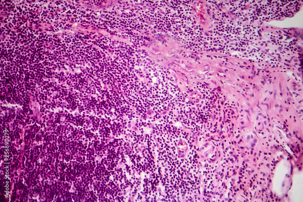 Acute simple appendicitis, light micrograph, photo under microscope ...