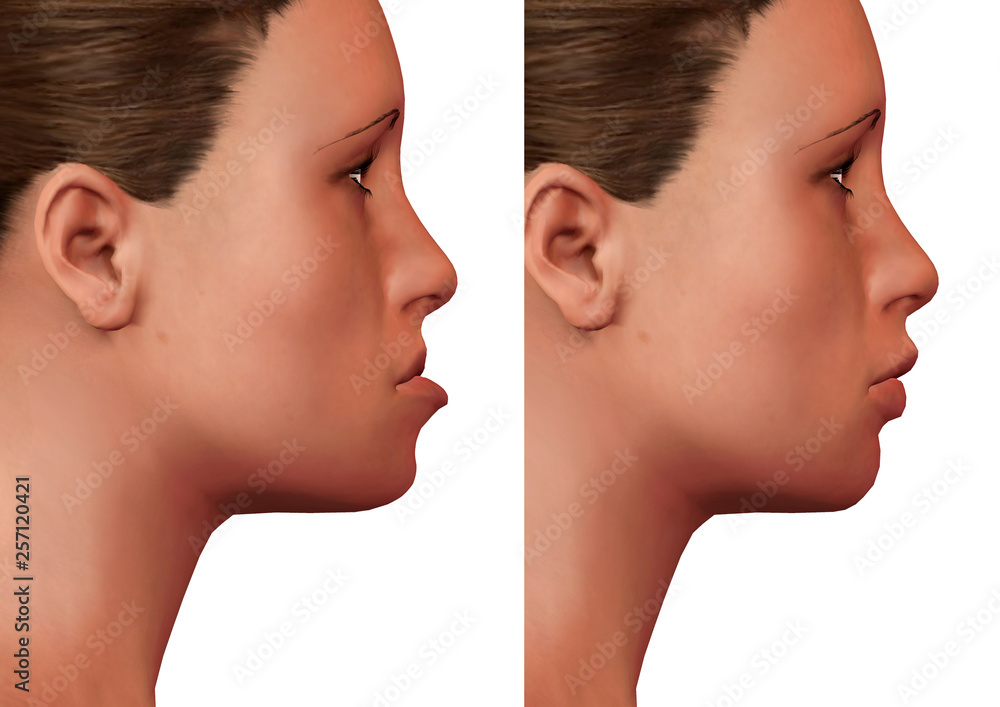 orthognathic surgery, correction of human mandible deformity, before ...