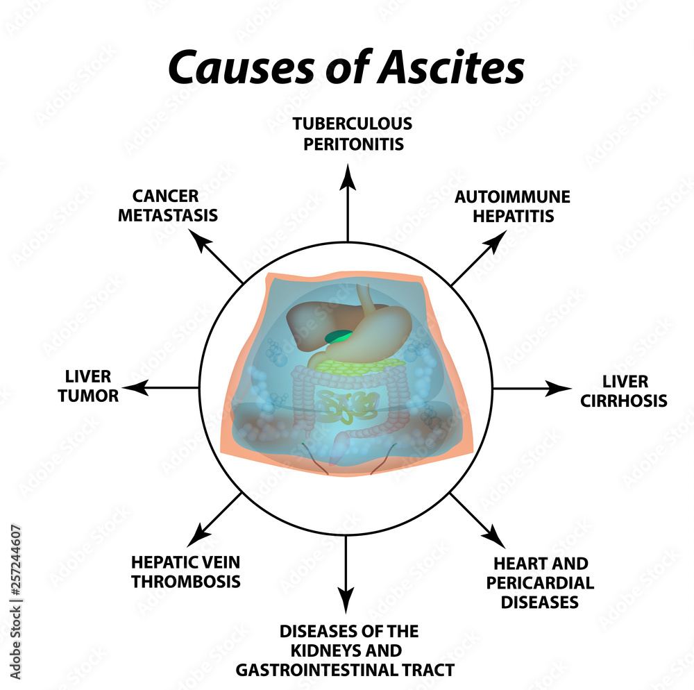 Ascites Free fluid in the abdominal cavity. Infographics. Vector ...