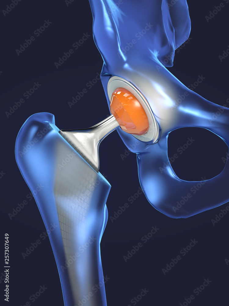 Function of a hip joint implant or hip prosthesis in frontal view - 3d ...