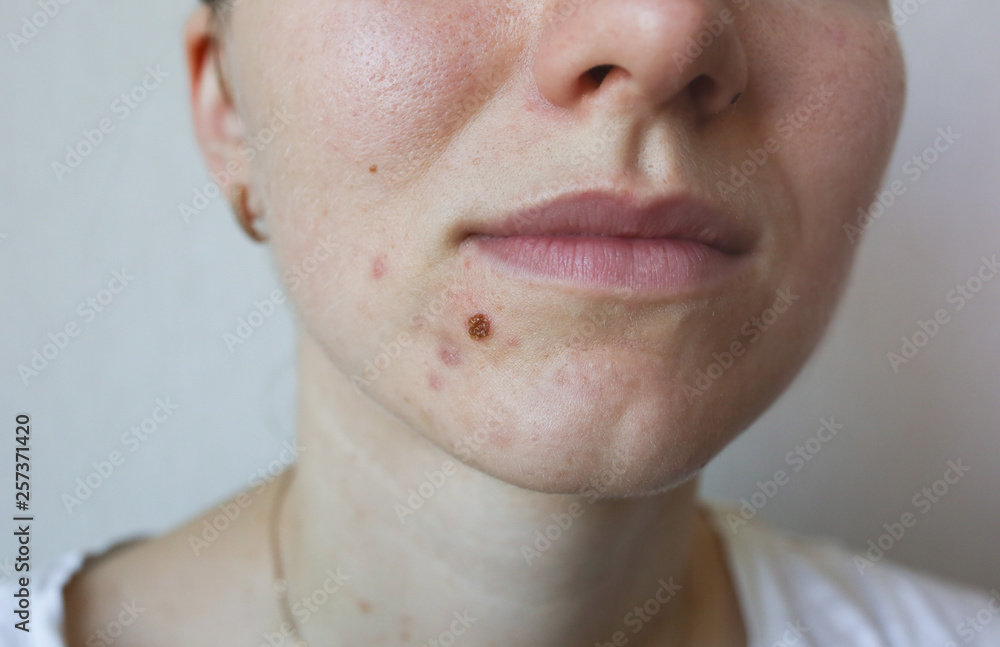 Scars and wounds on the face after acne. Removal of birthmarks and ...