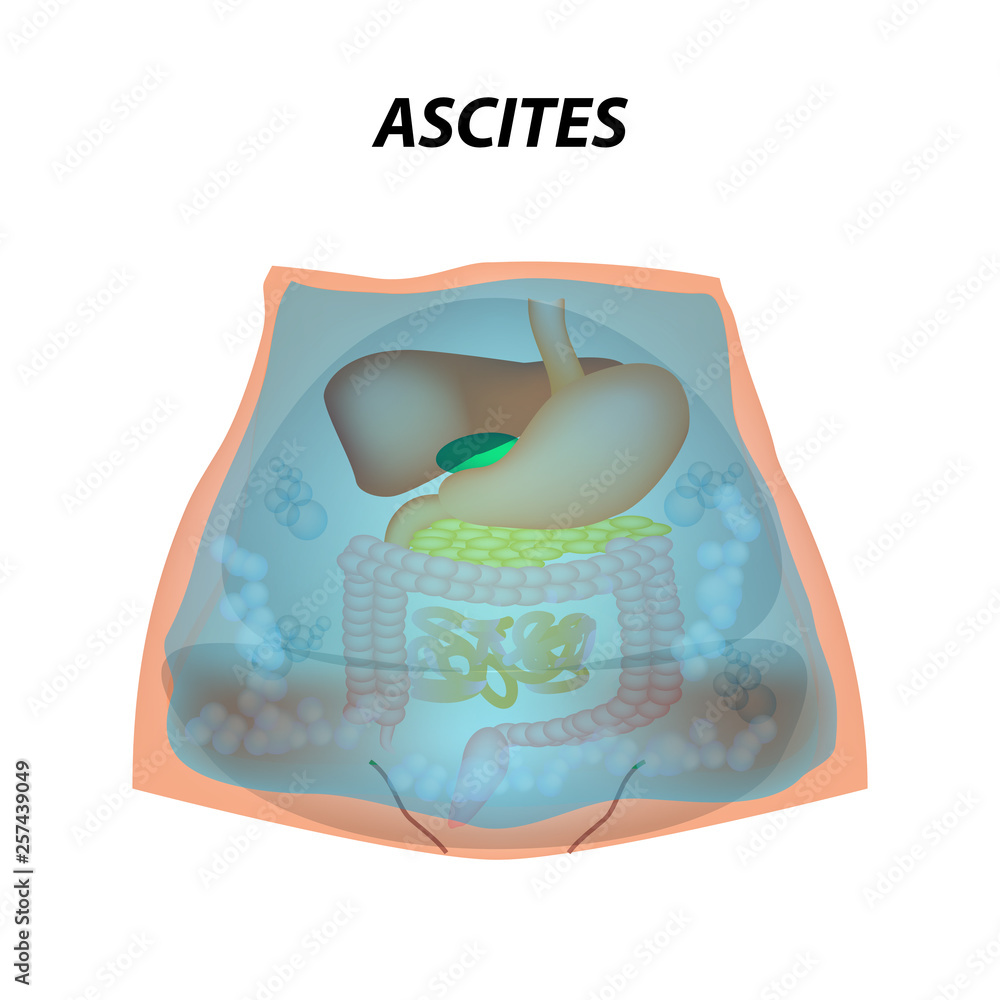 Ascites Free fluid in the abdominal cavity. Infographics. Vector ...