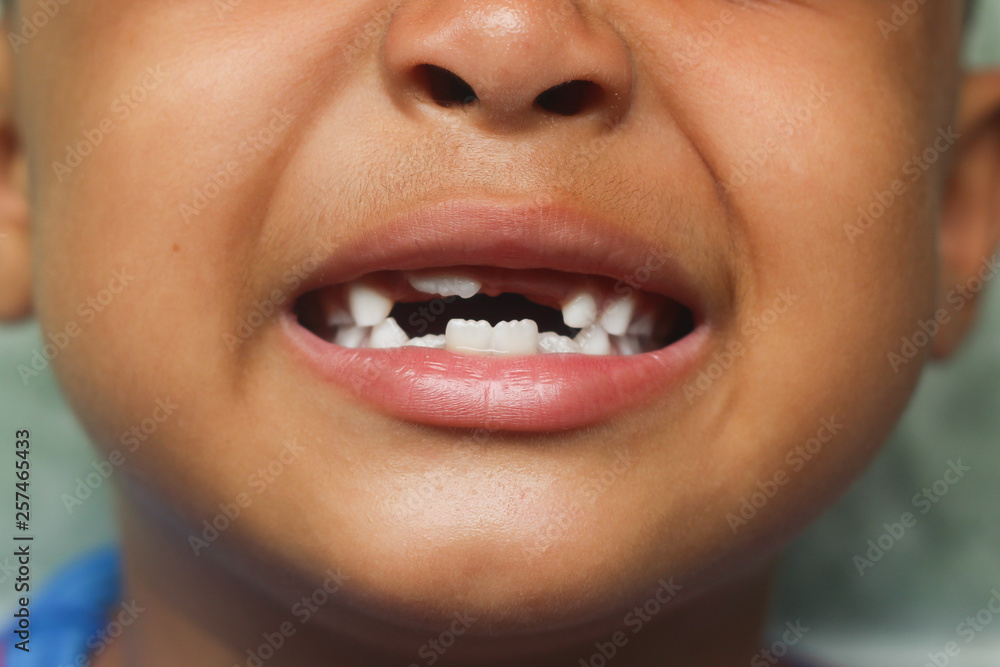 Little boy showing off his lost tooth. The child has a milk tooth and a ...
