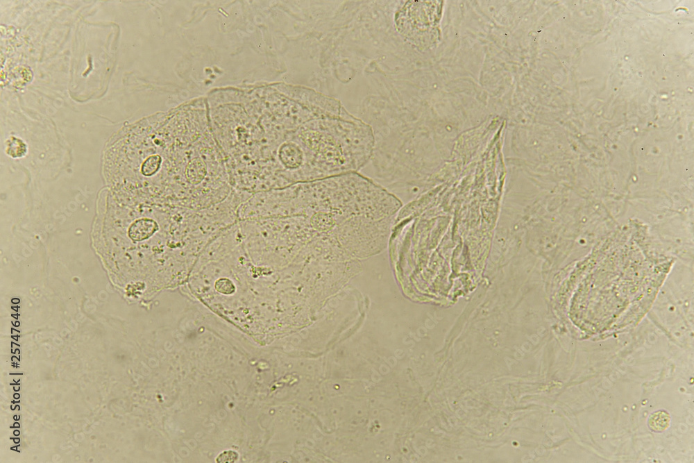 Epithelial cells with bacteria in patient urine, urinary tract ...