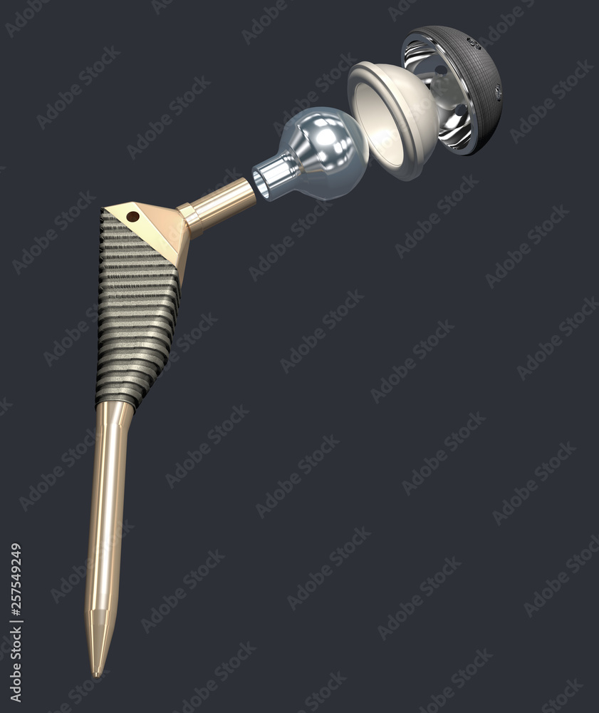 Function of a hip joint implant or hip prosthesis in frontal view - 3d ...