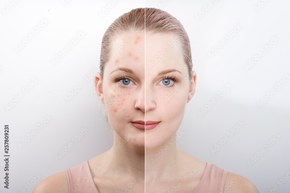 the girl's face before and after. difference after cosmetic procedures ...