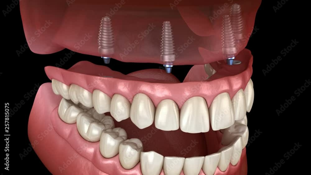 Maxillary prosthesis All on 4 system supported by implants. Medically ...