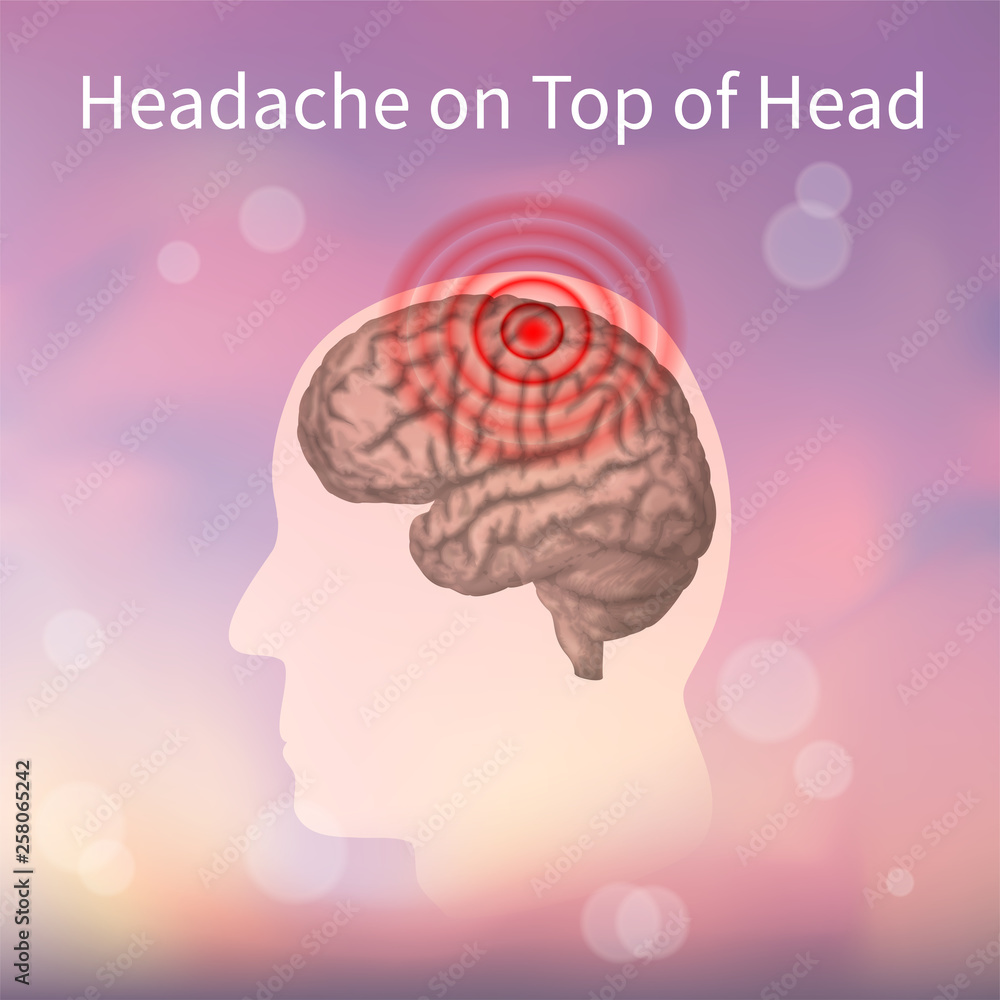 Headache on top of the head. Vector realistic anatomy illustration ...