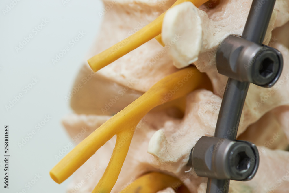 Close-up view of human lumbar spine model and instrumentation fixation ...