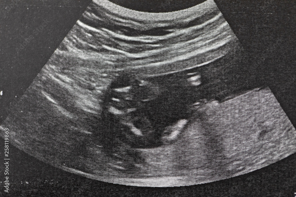 Ultrasound of baby in mother's at hospital. Stock Photo | Adobe Stock