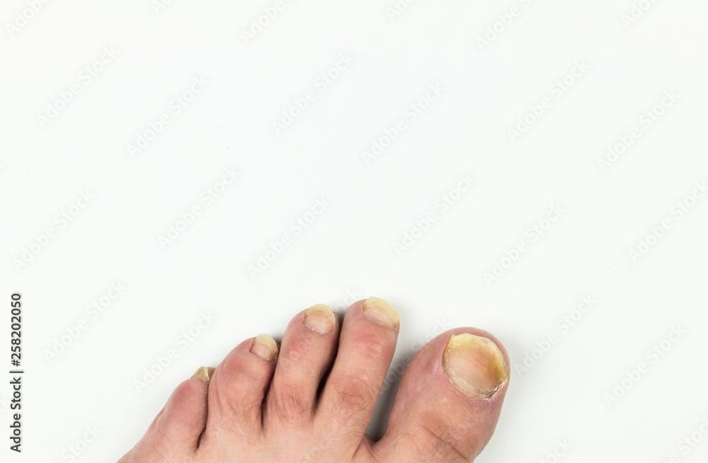 Uncut dirty toe nails left foot 3 Stock Photo | Adobe Stock