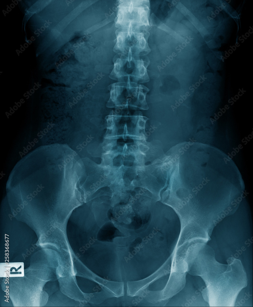 old man x-ray, lumbar x-ray image with pelvic bone Stock Photo | Adobe ...
