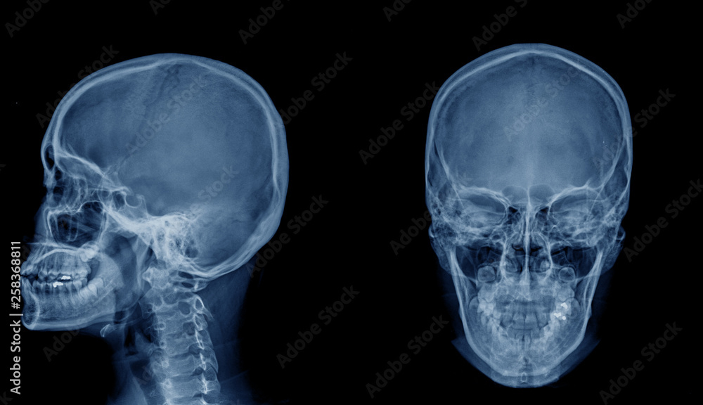 skull x-ray image AP Stock Photo | Adobe Stock