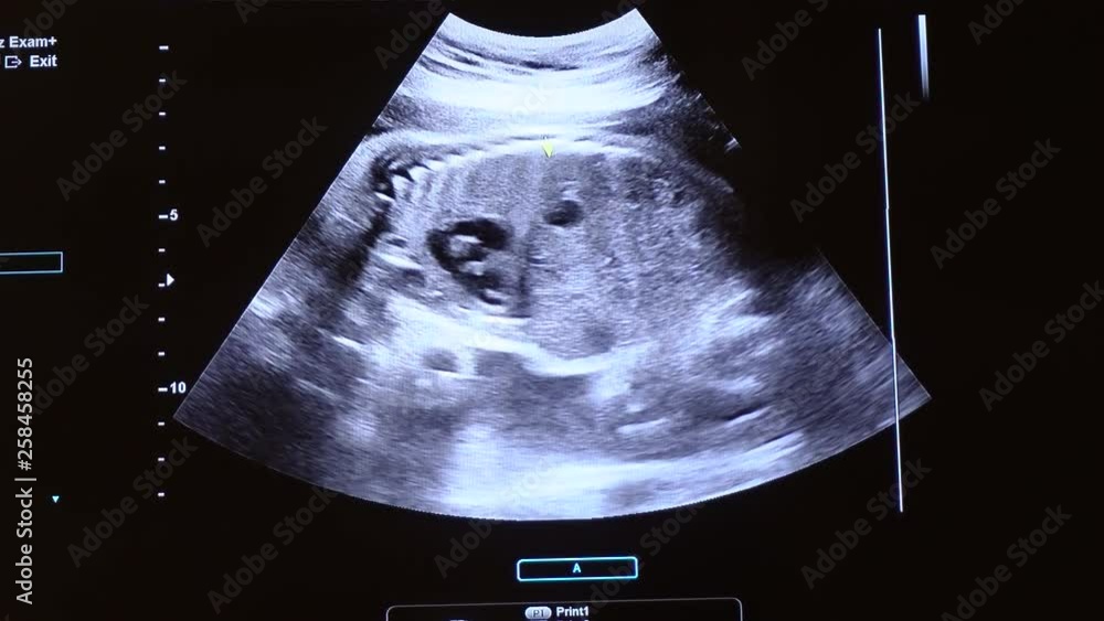 2D Ultrasound display of 28 weeks pregnant. Fetus ultrasound image that ...