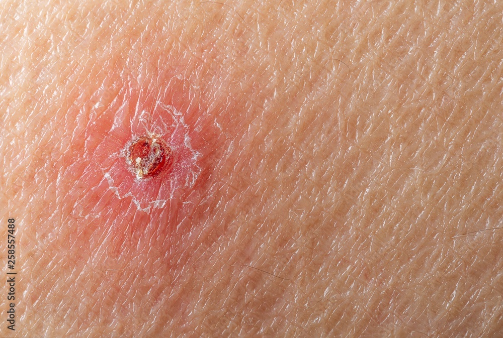 Close up picture of surface human skin and wound Stock Photo | Adobe Stock