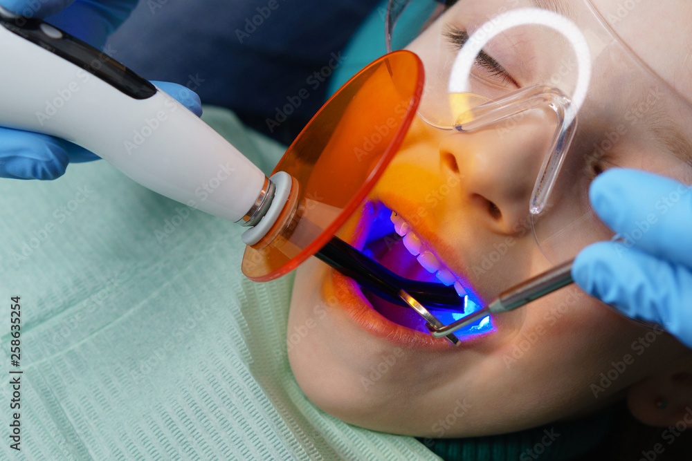 Dentist places filling on baby teeth of little girl. Treatment in ...