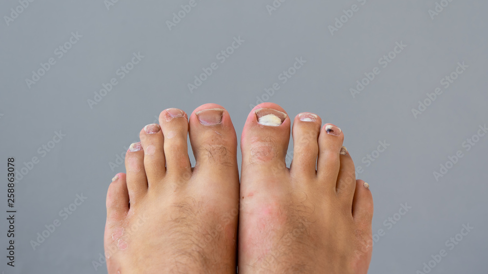 Both Feet On A Male Foot with a Fungal Infection in the Toe Nails which ...