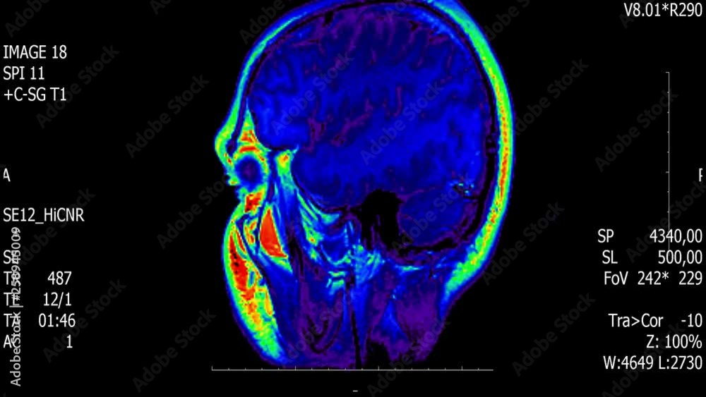 Stockvideo Real life man brain mri scan with tumor neoplasm medical ...