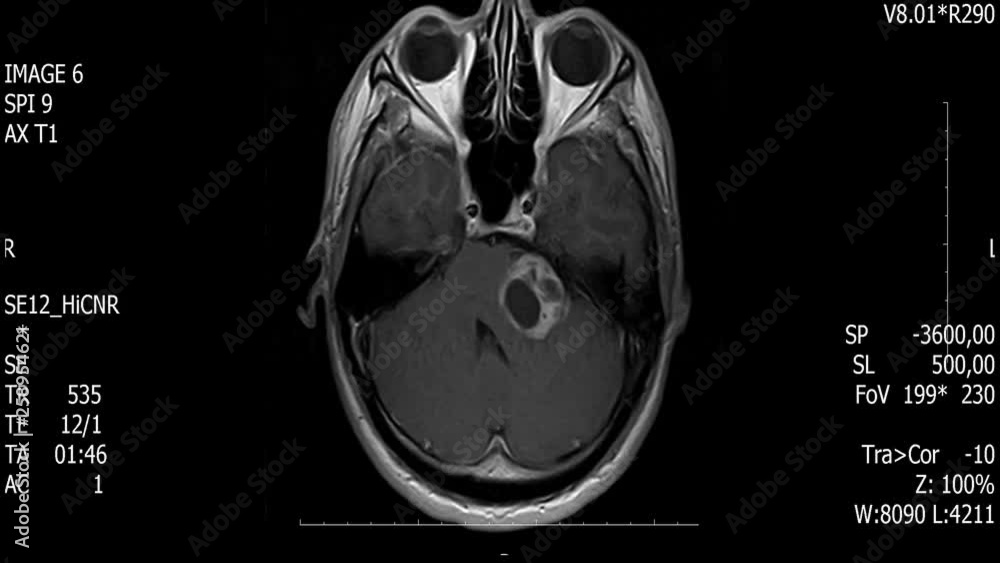 Real life man brain mri scan with tumor neoplasm medical reseach new ...