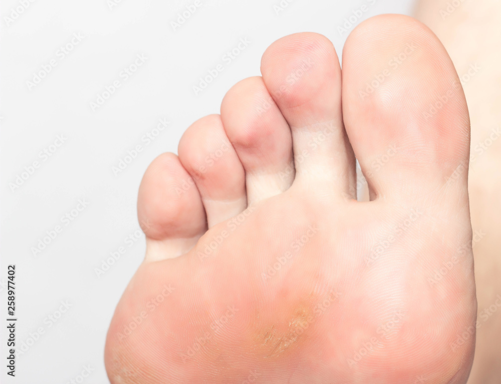 Dry mazol and natoptysh with an internal core on the sole and leg of a ...