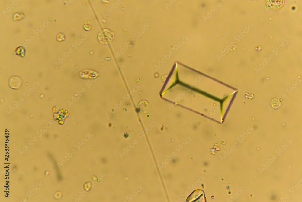 Triple Phosphate Crystals In Urine