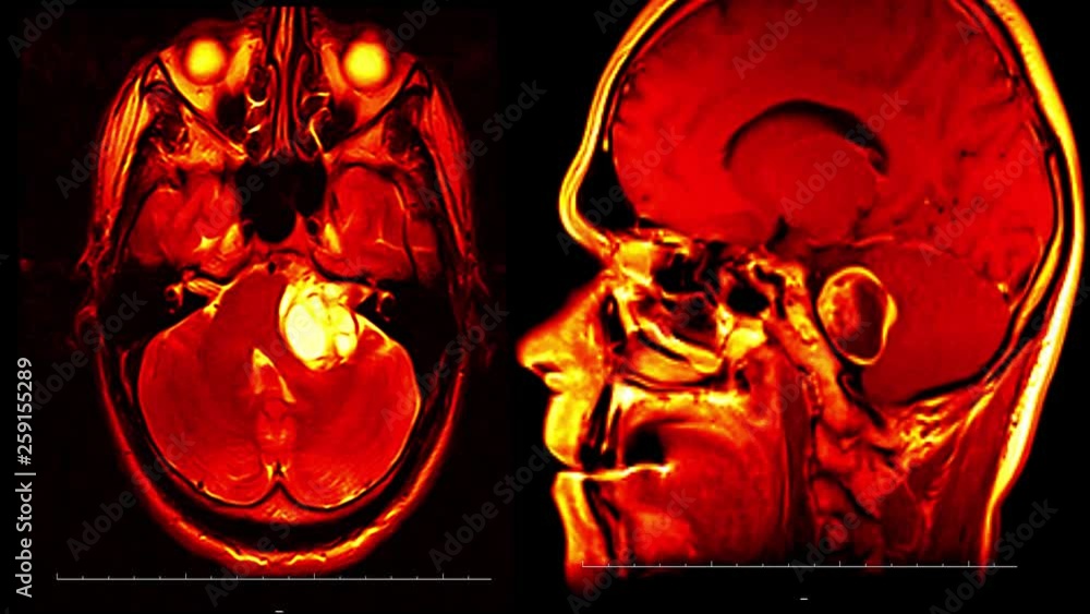 Real life man brain mri scan with tumor neoplasm medical reseach new ...