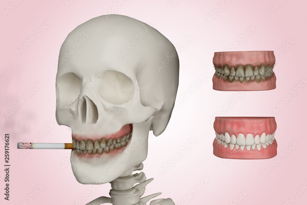 ภาพประกอบสต็อก smoker teeth, Tobacco Stains, dirty teeth before and ...