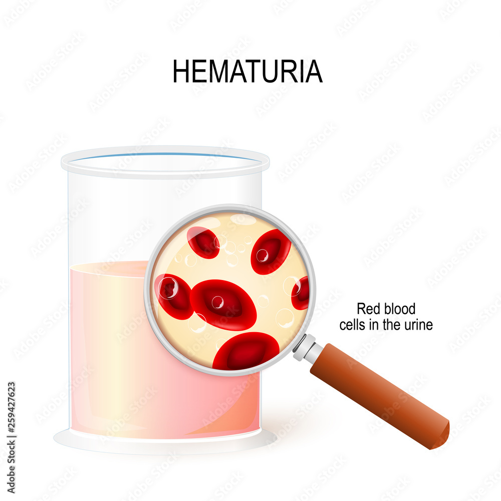 Hematuria. magnifying glass and beaker with urine. Closeup of Red blood ...