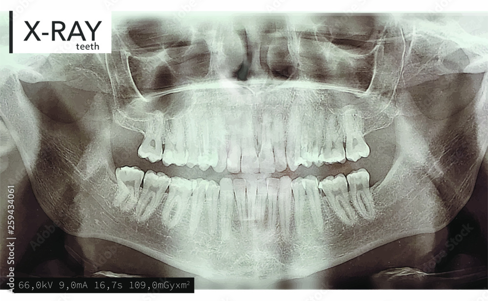 Xray teeth mouth dental tomography. Vector X-ray radiology oral ...